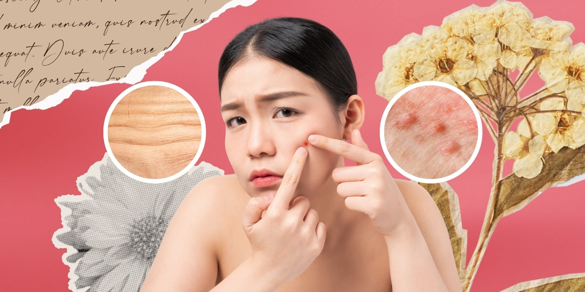 Stressed Out? Here’s How It Shows Up on Your Skin – NANA MALL